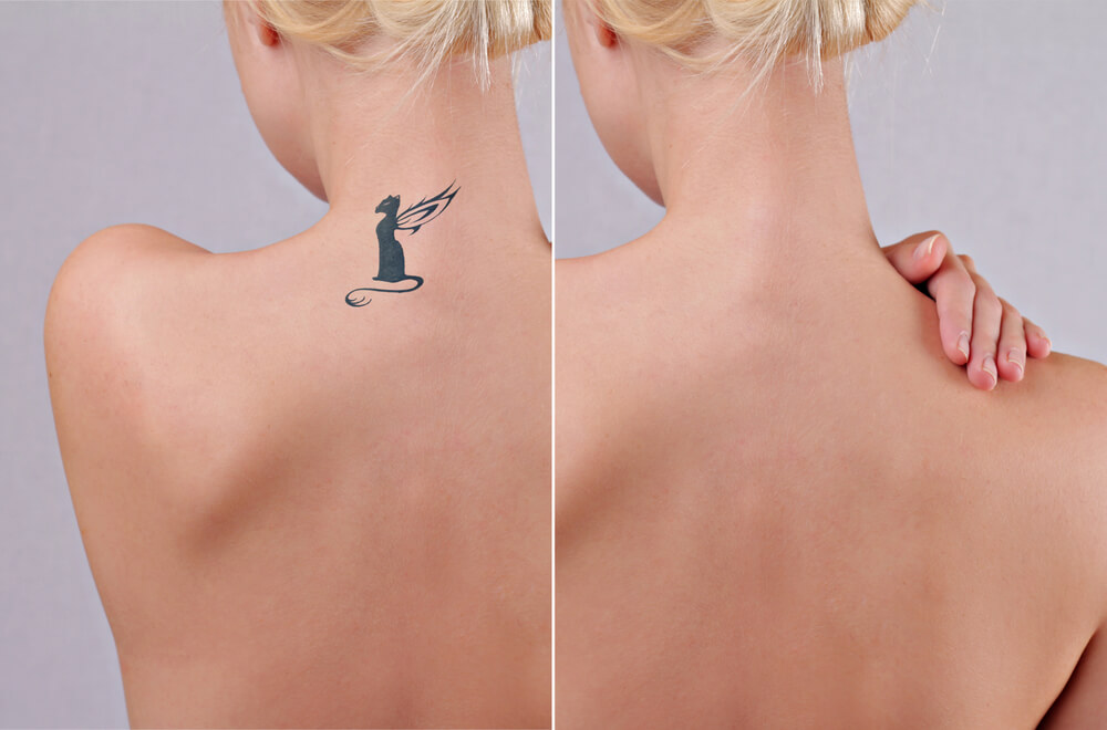 Erase Your Ink With Laser Tattoo Removal National Laser Institute