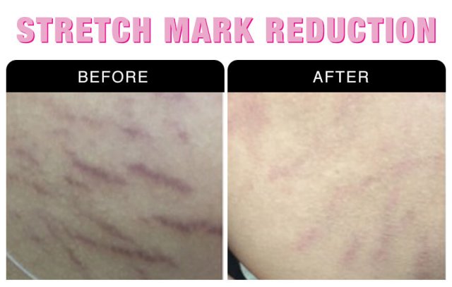 Stretch Mark Reduction | National Laser Institute Medical Spa